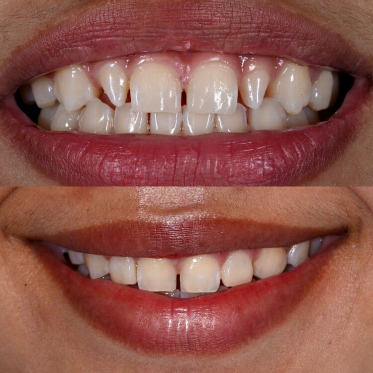 Treatment Options For Peg-Shaped Teeth