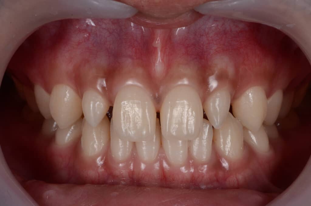 Treatment Options For Peg-Shaped Teeth