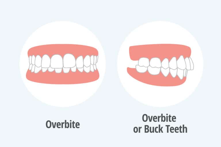 Overbite vs. Buck Teeth | Causes, Risks, and Treatment Options
